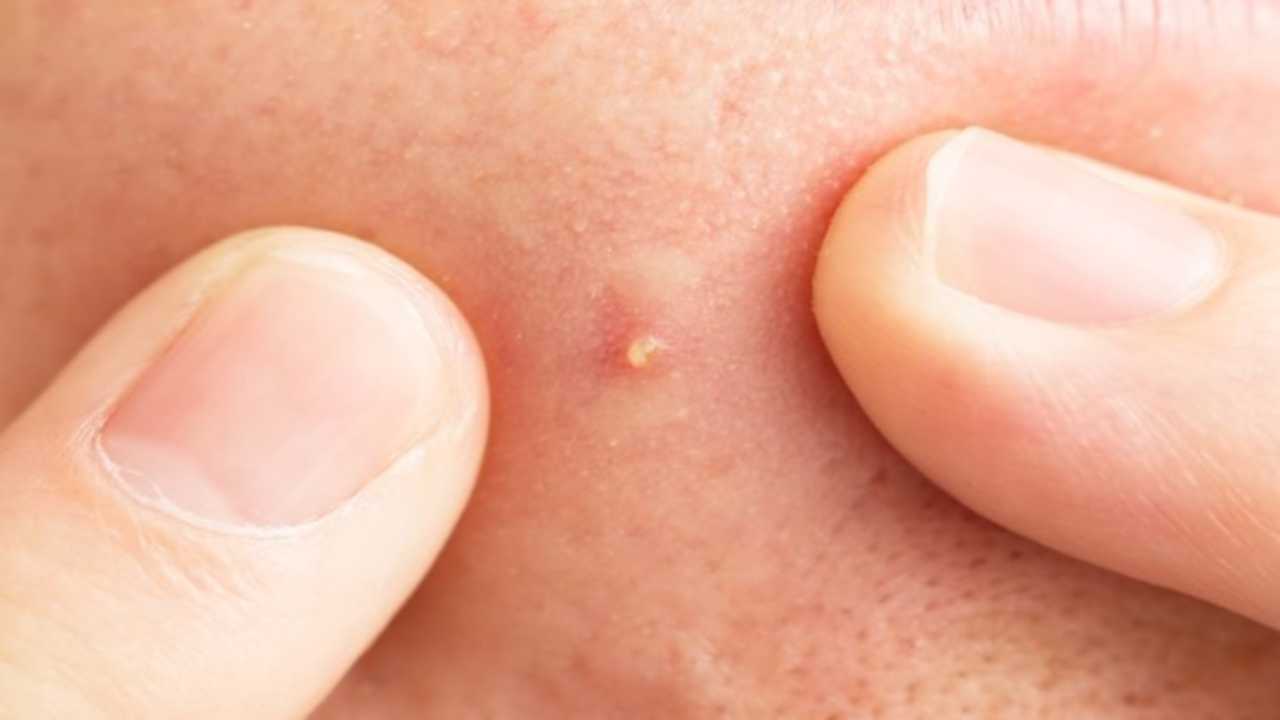 8 Effective Whiteheads Removal Techniques at Home » StylesXP